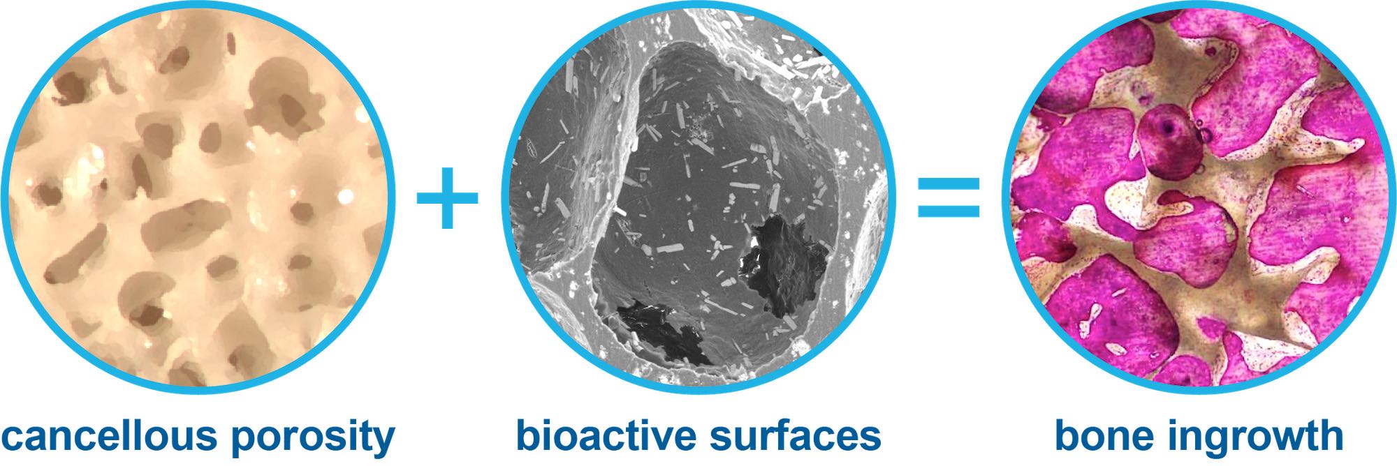 HAPPE Spine Announces Additional Patents